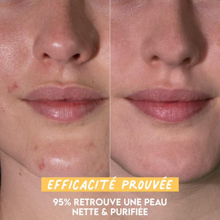 Lotion purifiante pour peaux à imperfections | Pulpe de Vie